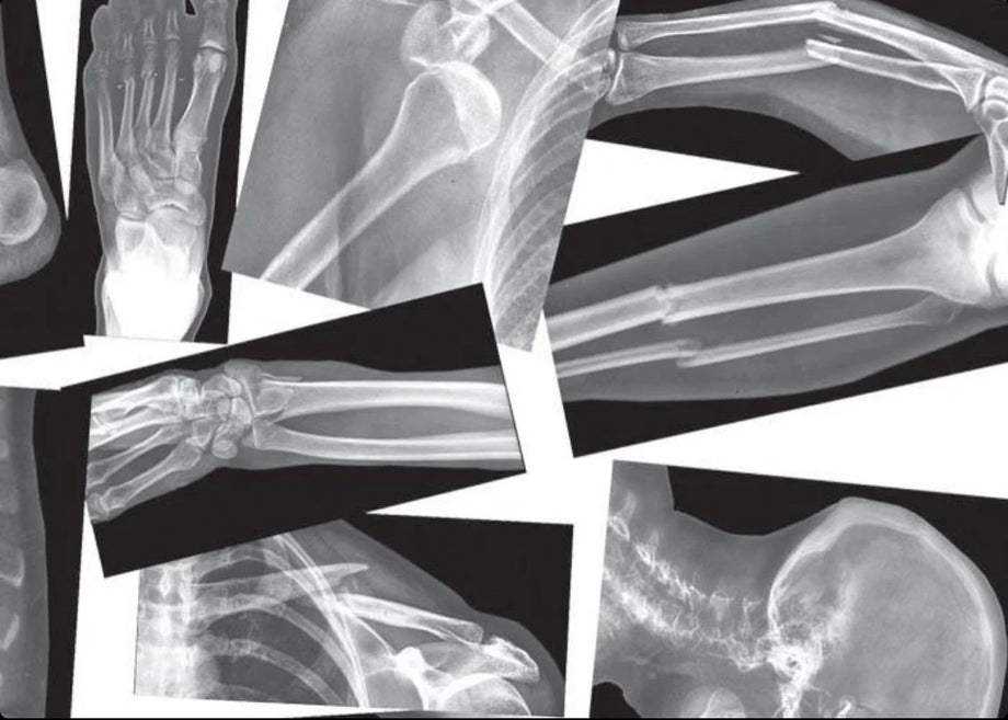 how do x rays detect broken bones